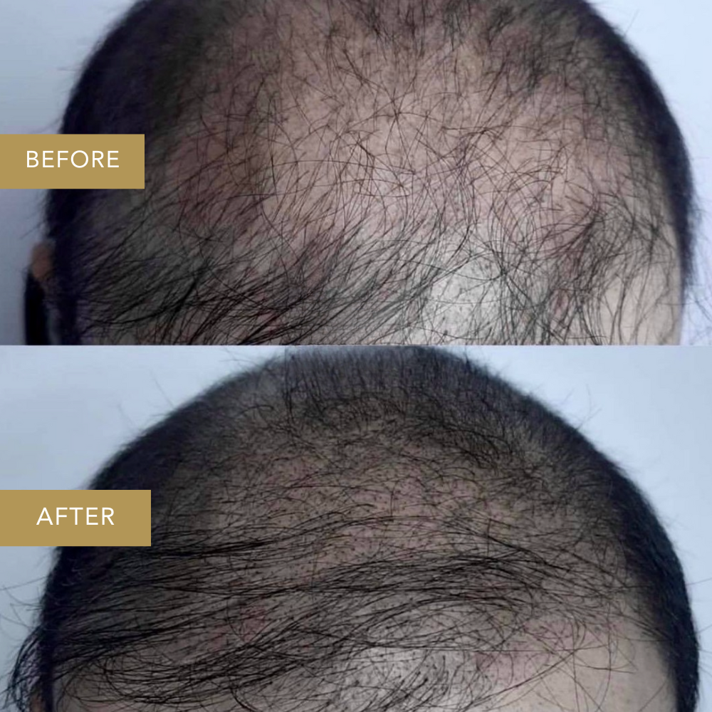 Permanent Makeup - Scalp Micro Pigment – The Brow Studio
